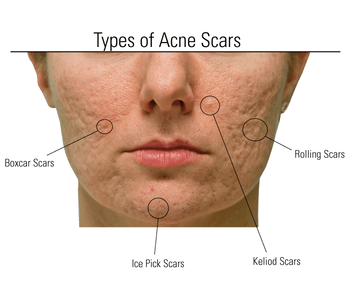 Acne Scars Elegance Clinic Acne Scars Elegance Clinic